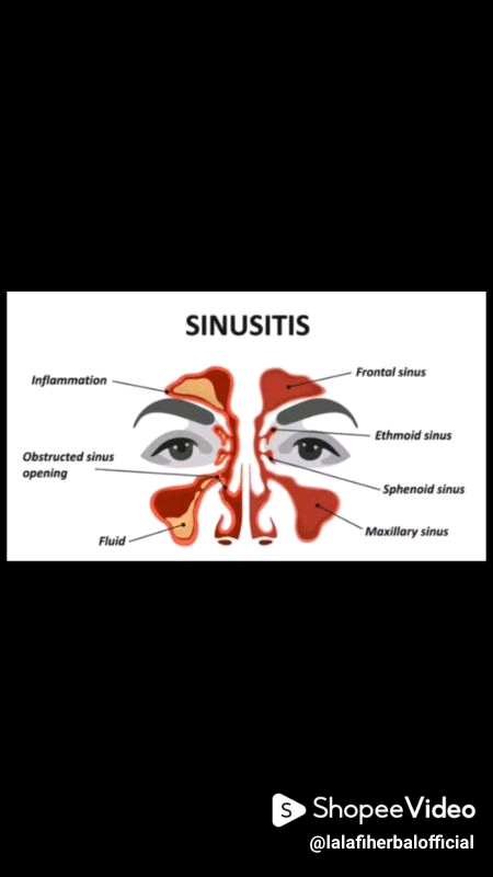 rekomendasi buat atasi sinusitis | Shopee Video Indonesia